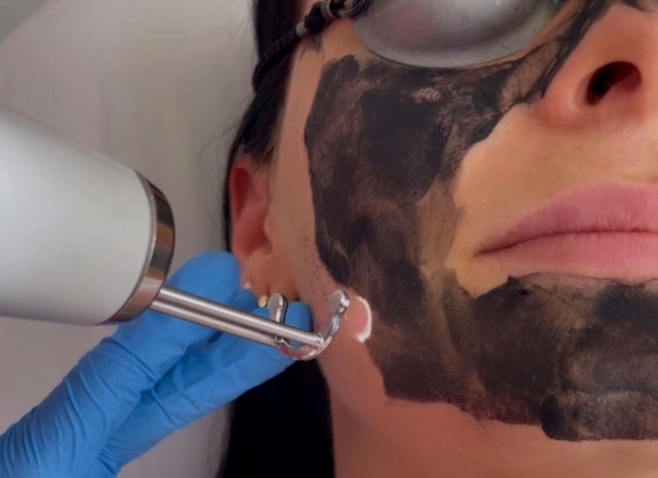 Carbon Peeling – Ordination Dr. med. Pavalec